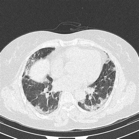 Radiopaedia Case Non Specific Interstitial Pneumonia Id 22166 Study