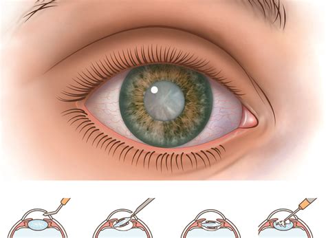 Catarata Nos Olhos Sintomas Causas E Cirurgia
