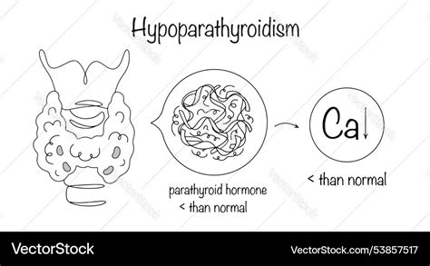 Hypoparathyroidism Royalty Free Vector Image Vectorstock