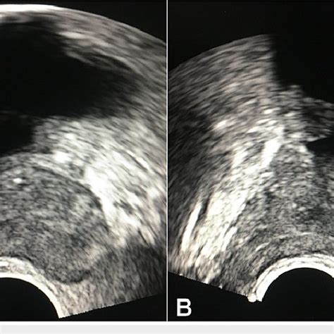 Ultrasound Ct Image Showing An Anteriorly Placed Midline Prostatic Cyst Download Scientific