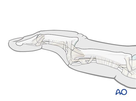 Dislocation Of The Proximal Interphalangeal Joint