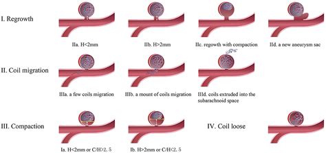 Frontiers Surgical Clipping Of Previously Coiled Recurrent Intracranial Aneurysms A Single