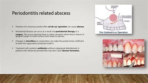 Abscess Of Periodontium Pptx