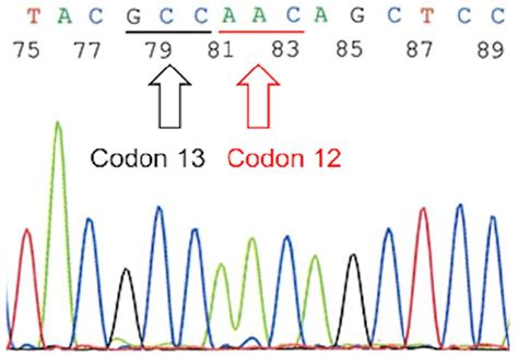 Direct Sequencing Of Kras Gene Codons 12 And 13 Shows A Ggt→gtt