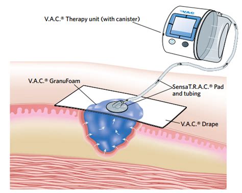 True Story How I Nearly Lost My Leg And How The Vac Saved It