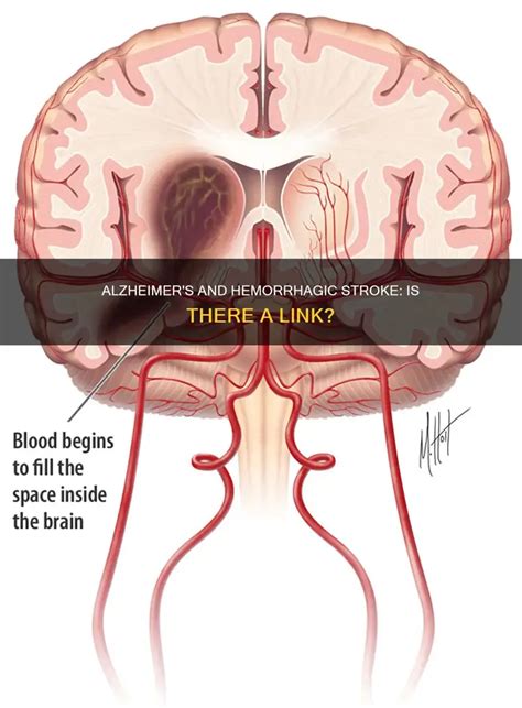 Alzheimers And Hemorrhagic Stroke Is There A Link Medshun