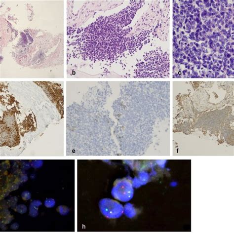 Biopsy Specimen From Primitive Neuroectodermal Tumor Pnet Of The Download Scientific Diagram