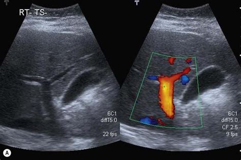 The Normal Hepato Biliary System Radiology Key The Normal Hepato Biliary System Radiology Key