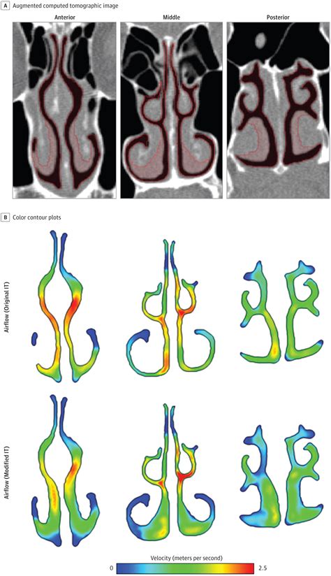 Computational Fluid Dynamics To Evaluate The Effectiveness Of Inferior Turbinate Reduction