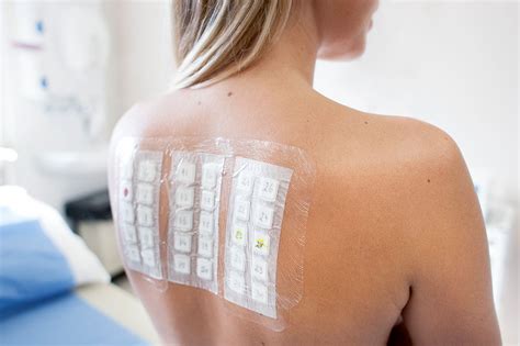 Allergy Patch Testing Explained Martha Stewart