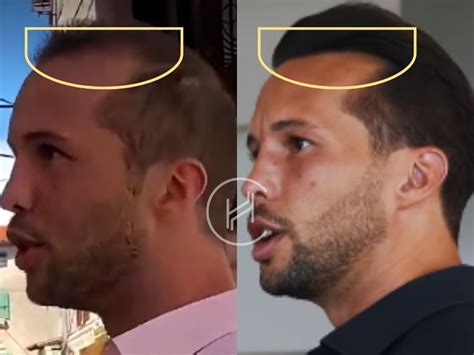 Tristan Tate Hair Transplant Hair Loss And Technical Analysis