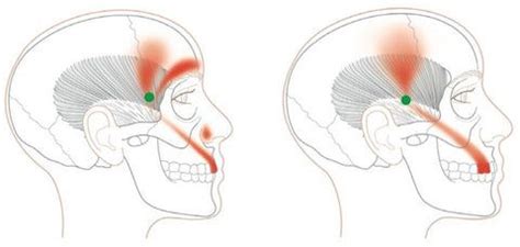 An Image Of A Man S Head And Neck With Red Arrows Pointing To The Left