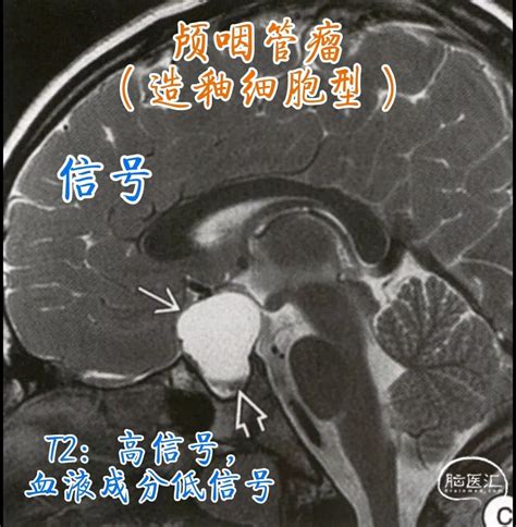 颅咽管瘤（craniopharyngioma） 脑医汇