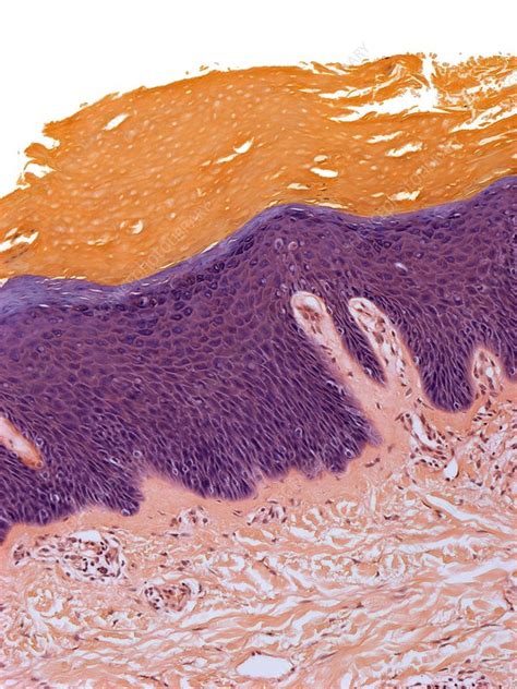Squamous Hyperplasia Light Micrograph Stock Image C0199484 Science Photo Library