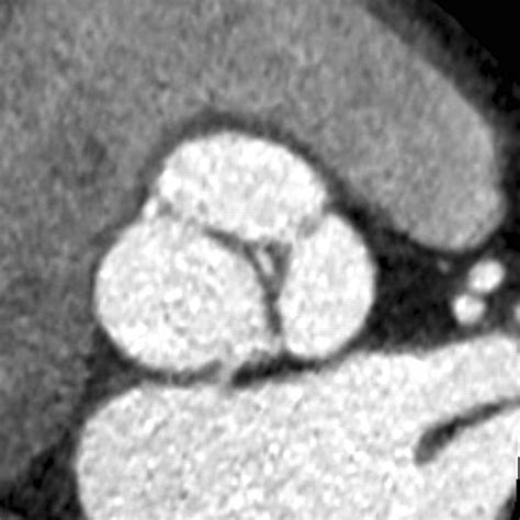 Cardiac Ct For The Differentiation Of Bicuspid And Tricuspid Aortic