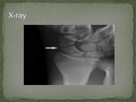 Scaphoid Fracture Power Point Ppt