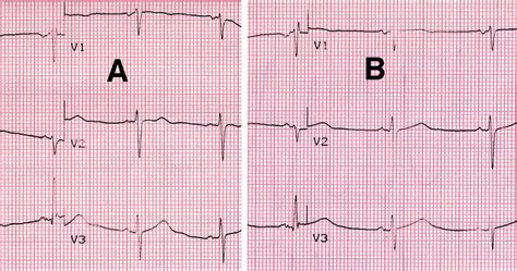 QT Interval Increased After Single Dose Of Lofexidine The BMJ