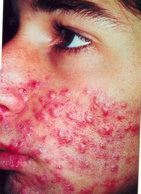 10 Hábitos Que Pueden Empeorar El Acné Derma Estetic