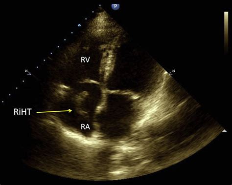 Echocardiographic Pattern Of Acute Pulmonary Embolism Analysis Of 511