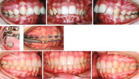 Fixed Functional Correction Of Class Ii Malocclusions Supported By Download Scientific Diagram