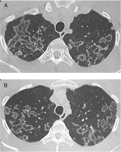 Pulmonary Histoplasmosis Presenting With The Reversed Halo Sign On High