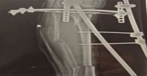 Segmental Tibia Fracture With Hybrid External Fixator Download
