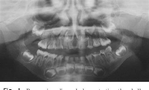 Figure 3 From Dentin Sialophosphoproteindspp Gene Mutation In A