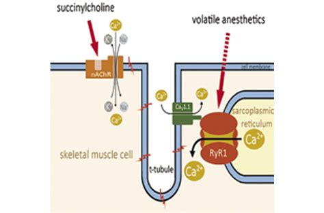 Malignant Hyperpyrexia