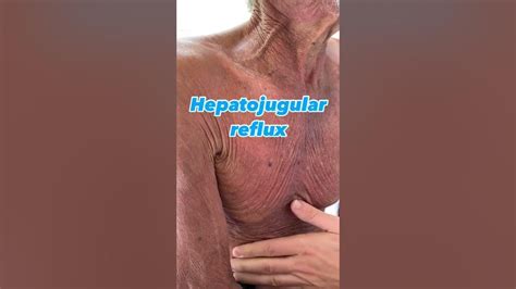 Hepatojugular Reflex Kaise Check Krte Hai Mbbs Neetpg Skill Heart