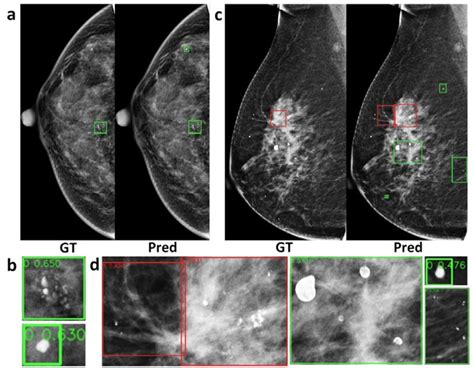 Artificial Intelligence Based Diagnosis Of Breast Cancer By Mammography Microcalcification