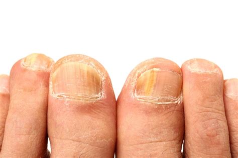 Mucocutaneous Candidiasis
