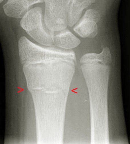 👉 Buckle Fracture Pictures Healing Time Treatment Causes February
