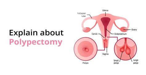 Cervical Polyps Symptoms