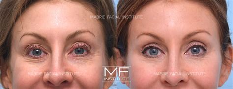 Under Eye Botox And Filler In The San Francisco Bay Area Mabrie Facial