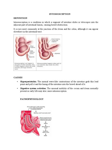 Intussusception Pdf Clinical Medicine Medical Specialties