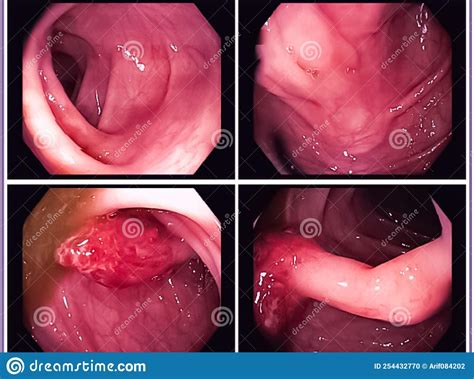 Colon Polyp Endoscope Inside Colonoscopy For Colon Polyps Search