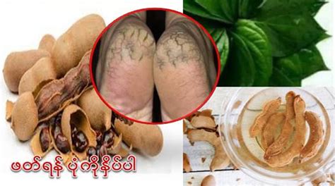 ခြေဖဝါးကွဲသူများအတွက် ၁ ရက်အတွင်း ပျောက်စေမည့် အိမ်တွင်းနည်းလမ်း