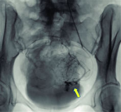 Transradial Access For Uterine Artery Embolization Typical Case Using Download Scientific