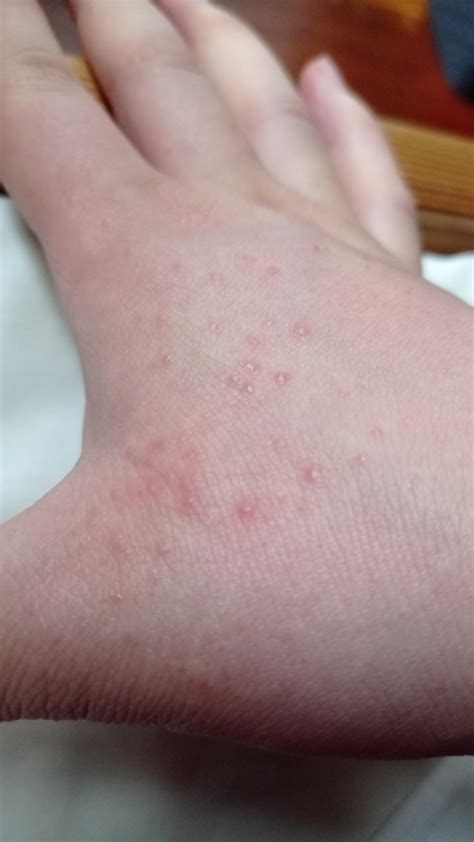 Do You Know What Are The Reasons For These Rashes On Back Of Hand And