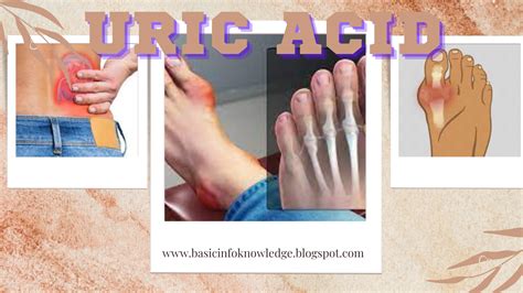 Uric Acid And Top 10 Best Medicines Of Uric Acid