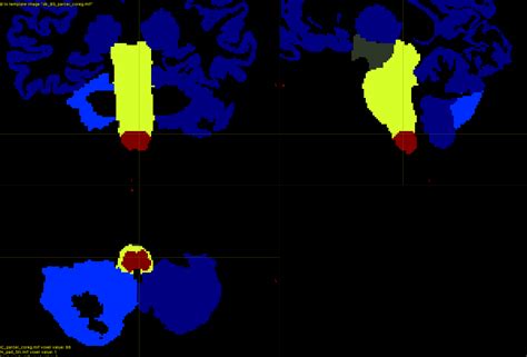 Automatically Defining Spinal Cord Roi For Custom Parcellation Tractography Mrtrix3 Community