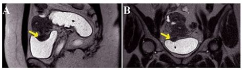 Identificação E Avaliação Da Endometriose Através Da Ressonância Magnética Da Pelve