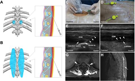 Visualised Continuous Espb Procedure A Diagram Of Espb B Diagram Download Scientific