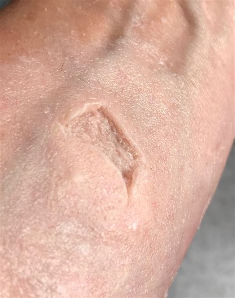 Encapsulated Sfx Silicone Damaged Skin Prosthetic Etsy