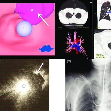 A The Target Lesion As Seen On Virtual Bronchoscopic Navigation Download Scientific Diagram