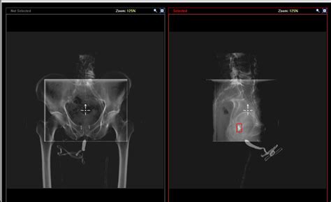 Mosaiq Registration Tool With Highlighted Fiducial Markers Download