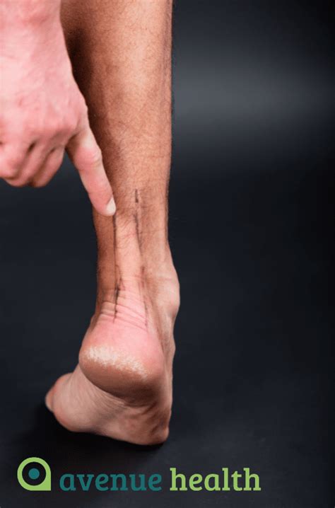 Simple Exercises For Insertional Achilles Tendonitis Relief 53 Off