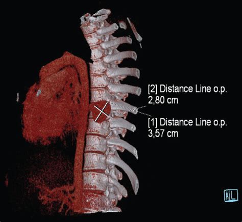 Computed Tomography Pulmonary Angiography At 25⁺⁴ Weeks Of Pregnancy Of