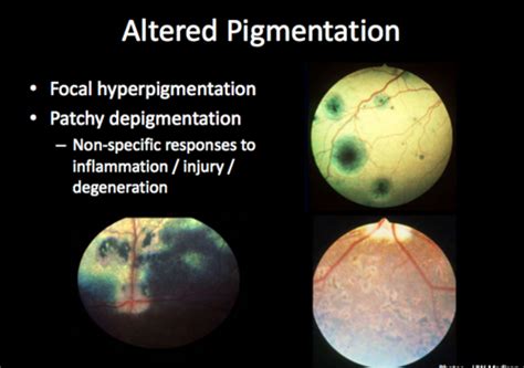 Focal Hyperpigmentation