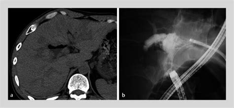 Combined Endoscopic Lithotripsy And Percutaneous Transhepatic Cholangioscopy Therapy For